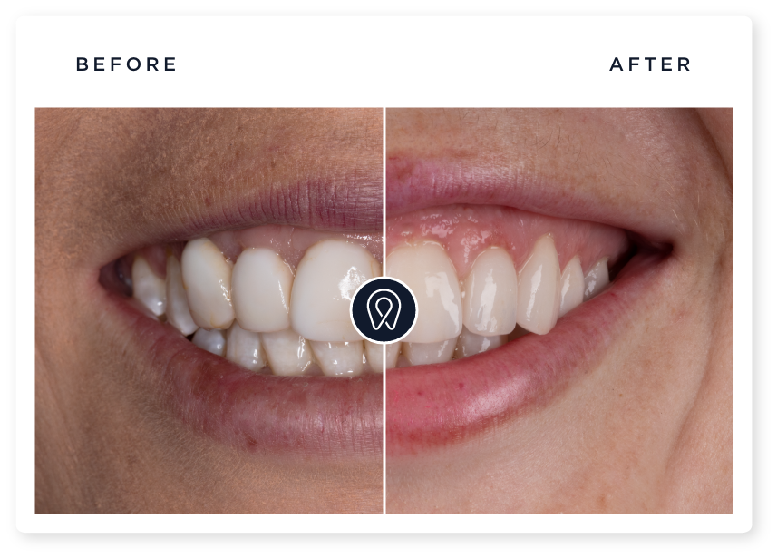 Composite Veneers Vs Porcelain Veneers Sydney Smile Doctor